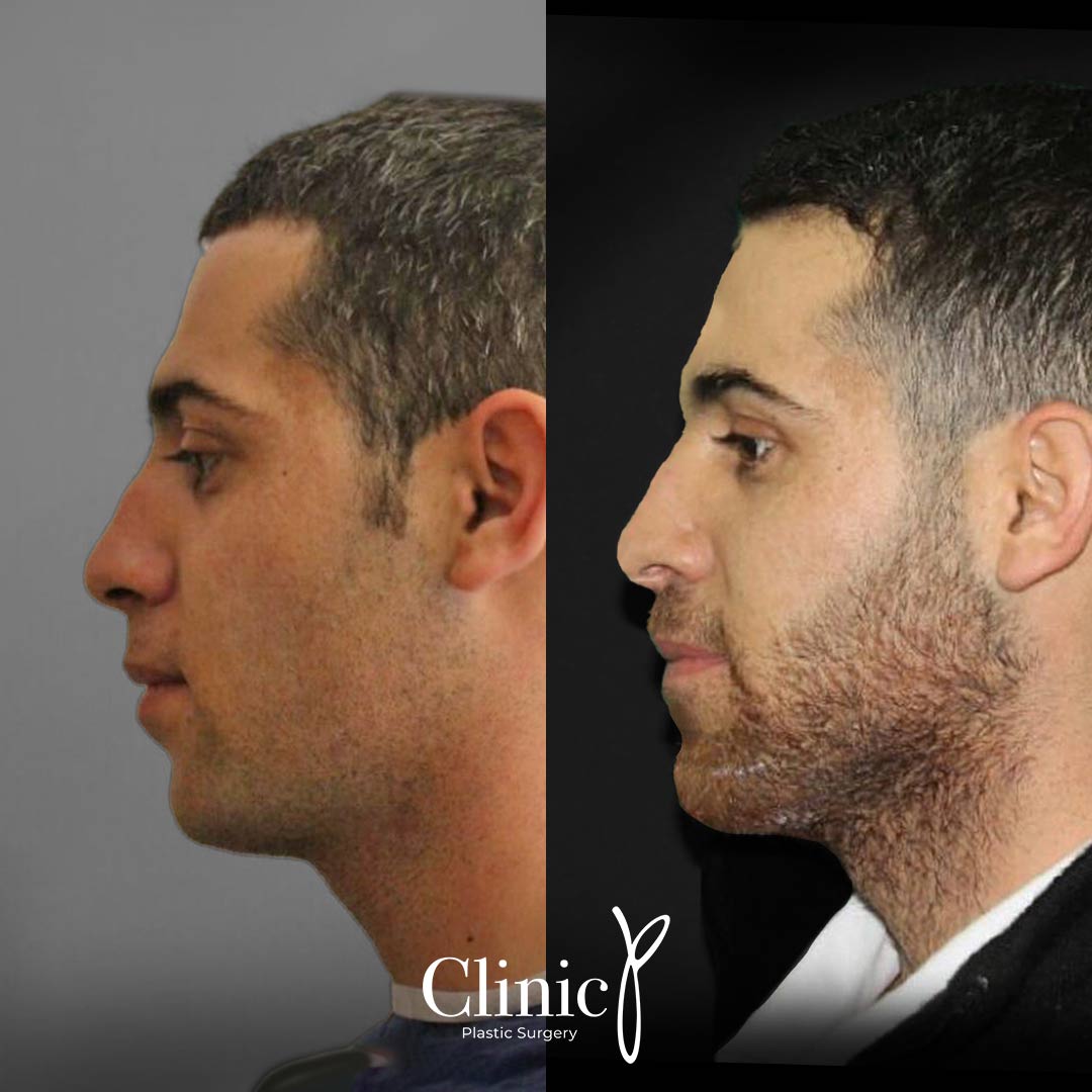 Chin Plastic Surgery – Clinic P | Aesthetic Surgery Turkey