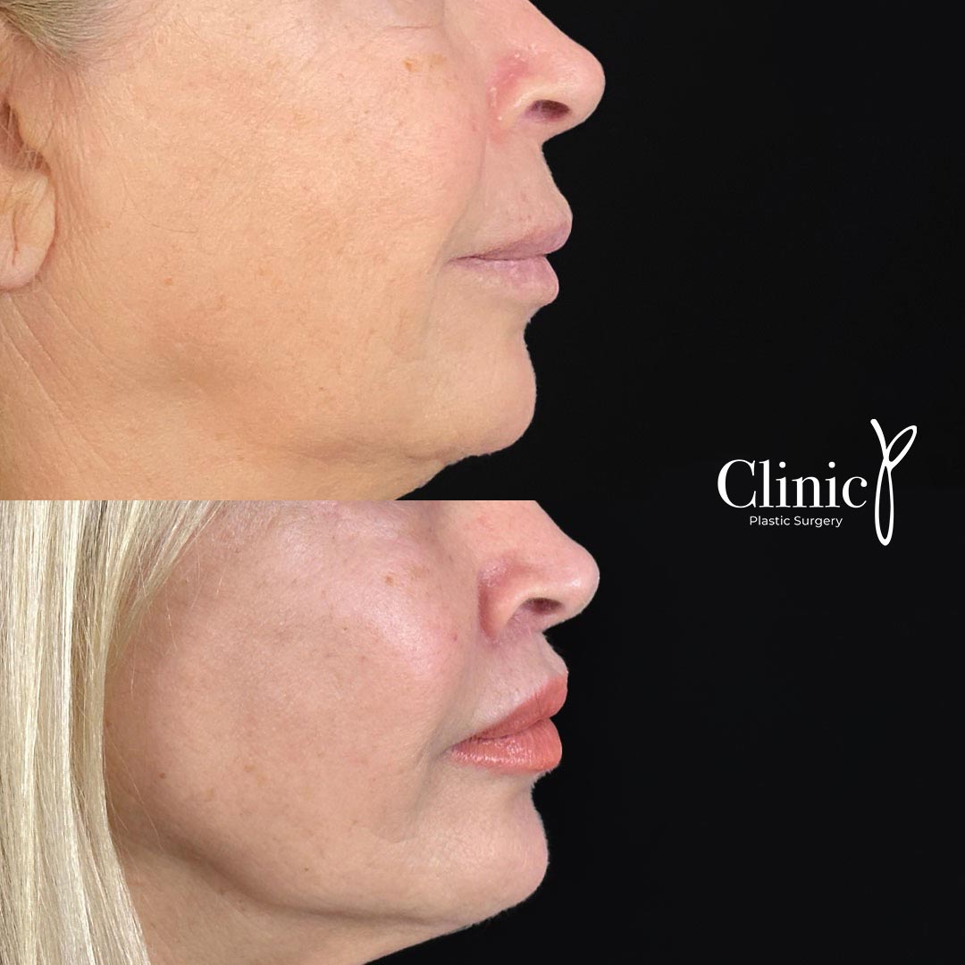 Lip Lift – Clinic P | Aesthetic Surgery Turkey