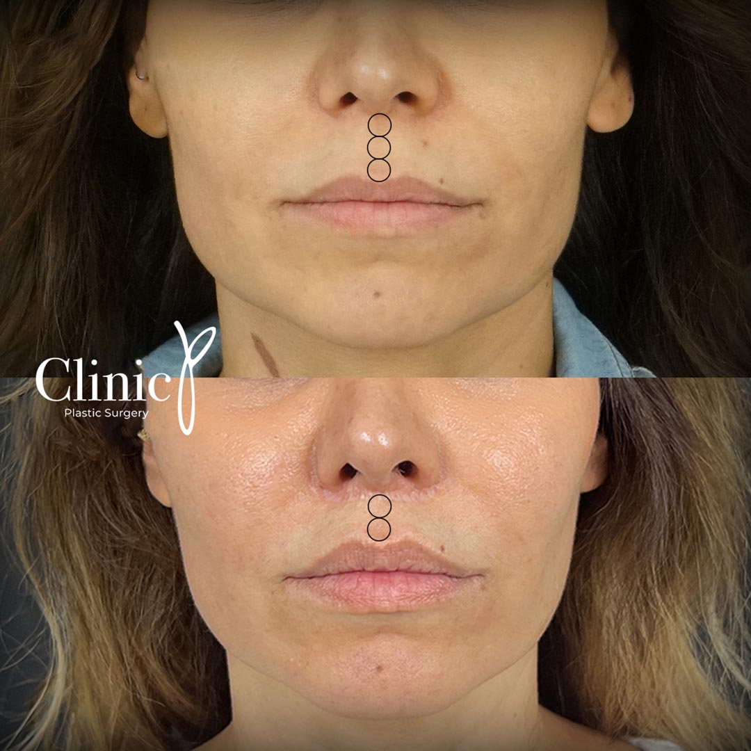 Lip Lift – Clinic P | Aesthetic Surgery Turkey